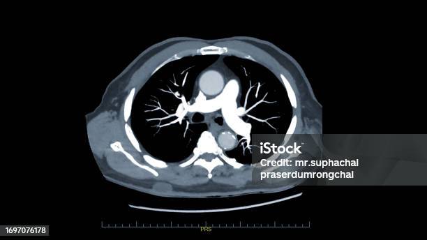 Ctpa Atau Cta Arteri Pulmonalis Untuk Diagnostik Pulmonary Embolism
