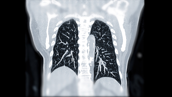 Ctpa Atau Cta Arteri Pulmonalis Untuk Diagnostik Pulmonary Embolism