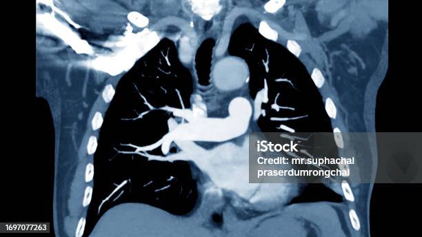 Ctpa Atau Cta Arteri Pulmonalis Untuk Diagnostik Pulmonary Embolism