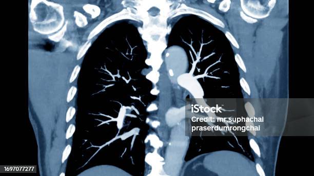Ctpa Atau Cta Arteri Pulmonalis Untuk Diagnostik Pulmonary Embolism