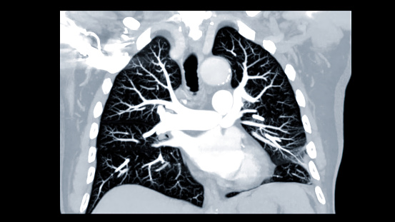 Ctpa Atau Cta Arteri Pulmonalis Untuk Diagnostik Pulmonary Embolism