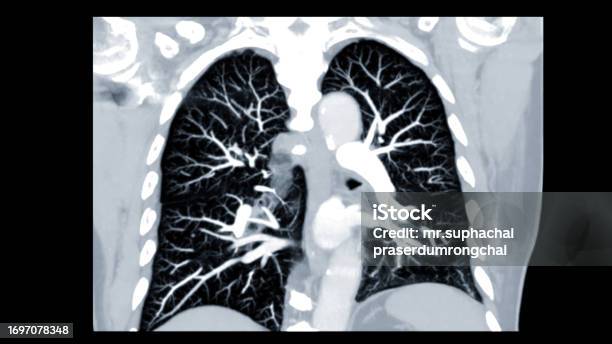 Ctpa Atau Cta Arteri Pulmonalis Untuk Diagnostik Pulmonary Embolism