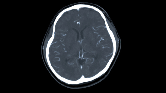 Ct Scan Otak Dengan Media Kontras Injeksi Untuk Diagnosis Tumor Otak