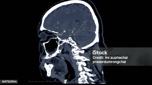 Ct Scan Otak Dengan Media Kontras Injeksi Untuk Diagnosis Tumor Otak