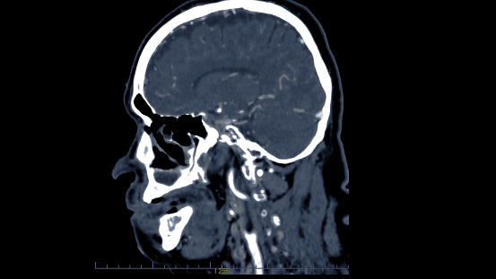 Ct Scan Otak Dengan Media Kontras Injeksi Untuk Diagnosis Tumor Otak