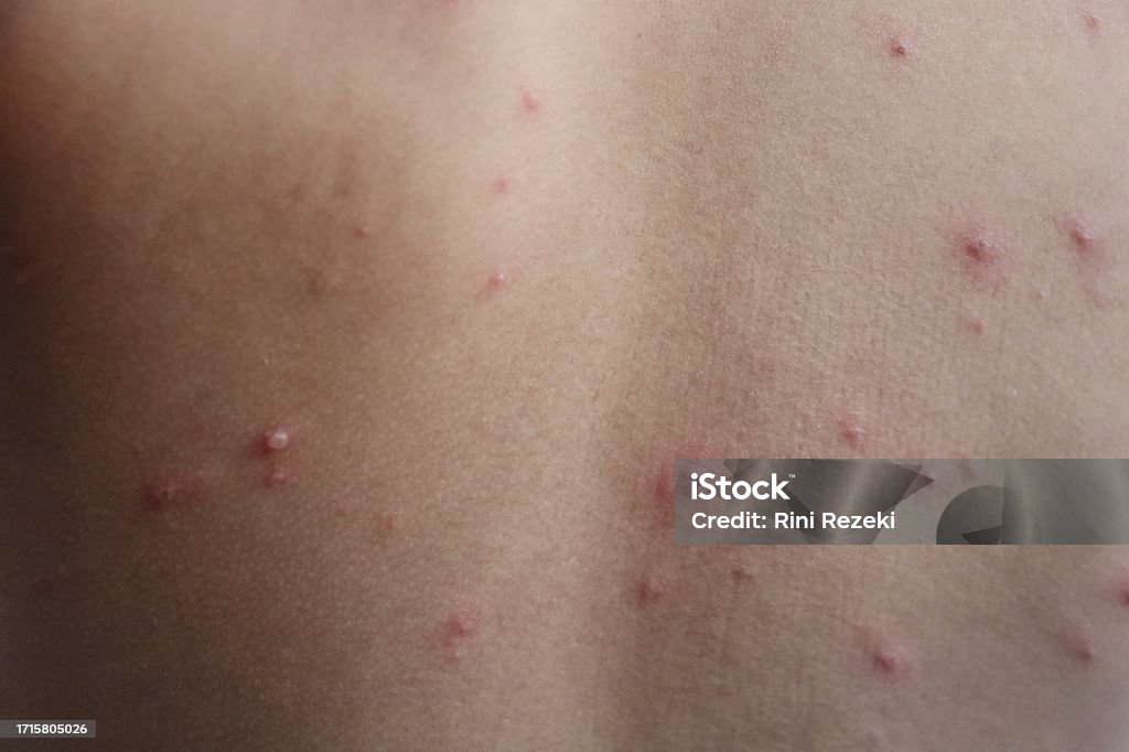 Measles Stock Photo - Download Image Now - Measles, Pox, Allergy - iStock Measles Stock Photo - Download Image Now - Measles, Pox, Allergy - iStock