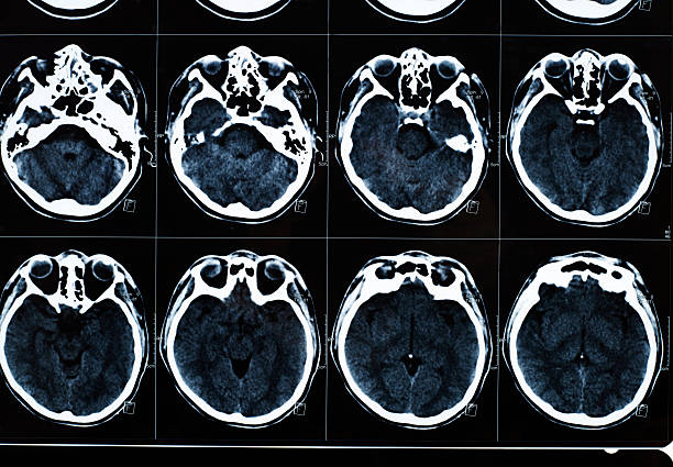 22.300+ Tumor Otak Foto Foto Stok, Potret, & Gambar Bebas Royalti - iStock 22.300+ Tumor Otak Foto Foto Stok, Potret, & Gambar Bebas Royalti - iStock