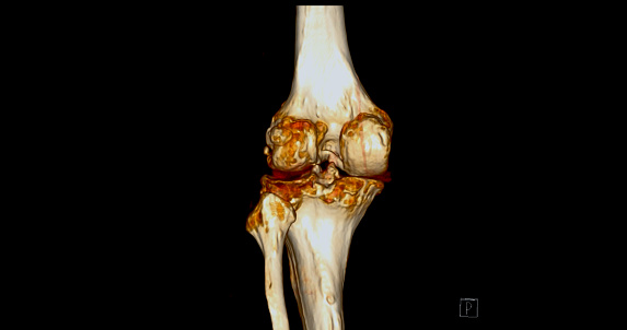 Photo Libre De Droit De Ct Scan De Larticulation Du Genou Montrant