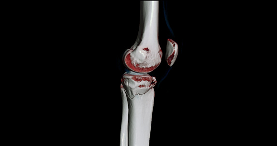 Photo Libre De Droit De Ct Scan De Larticulation Du Genou Montrant