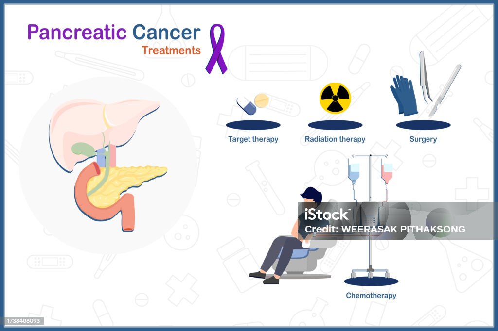 Pancreatic Cancer Treatments Stock Illustration Download Image Now