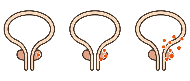 Vector Illustration Of Prostate Cancer Stock Illustration Download Image Now Prostate Cancer