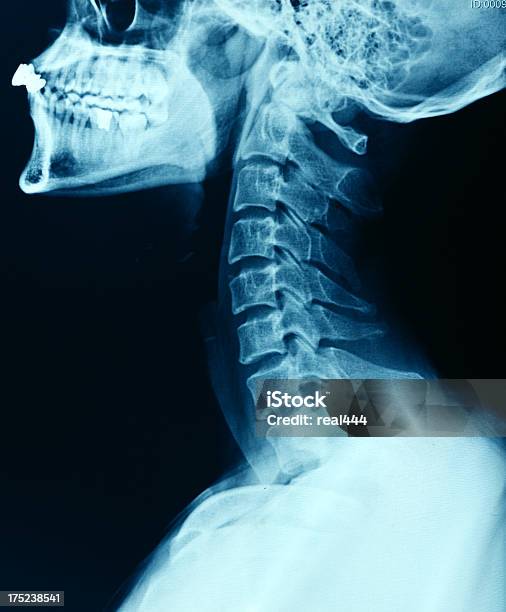 X선 영상 엑스레이 이미지에 대한 스톡 사진 및 기타 이미지 엑스레이 이미지 척추 신체 부분 목뼈 Istock