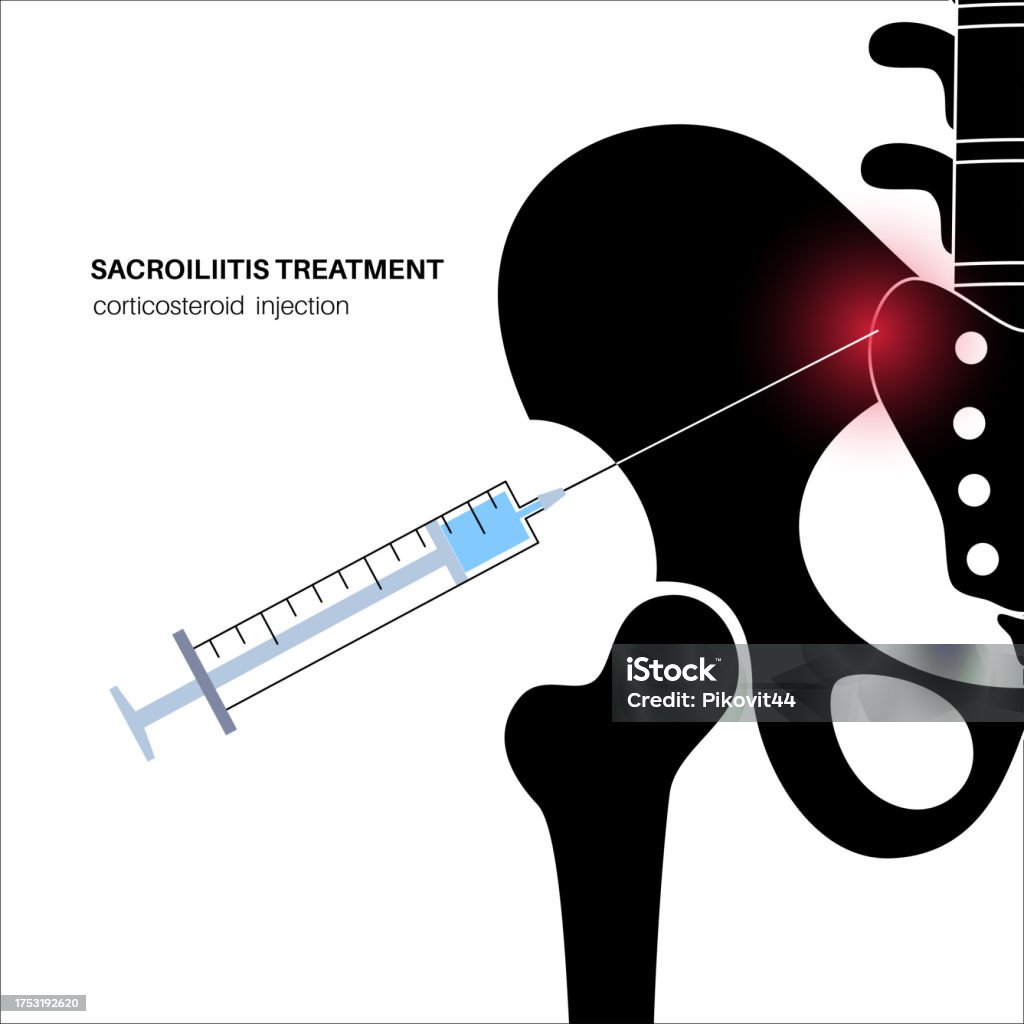 Sacroiliitis Corticosteroid Injections Stock Illustration Download Image Now Anatomy