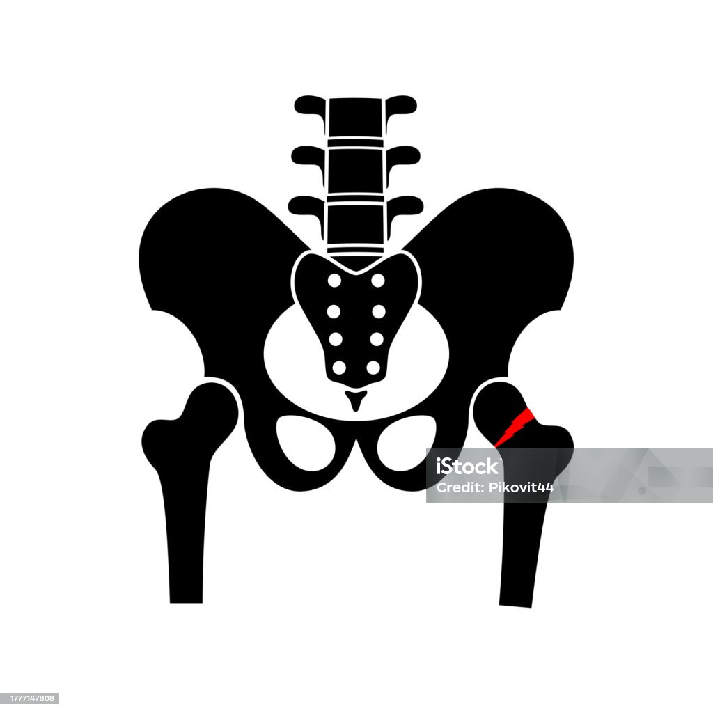Hip Bone Fracture Stock Illustration Download Image Now Anatomy Bone Bone Fracture Istock