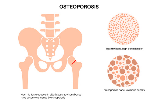 Medizinisches Poster Zu Osteoporose Stock Vektor Art und mehr Bilder ... Medizinisches Poster Zu Osteoporose Stock Vektor Art und mehr Bilder ...