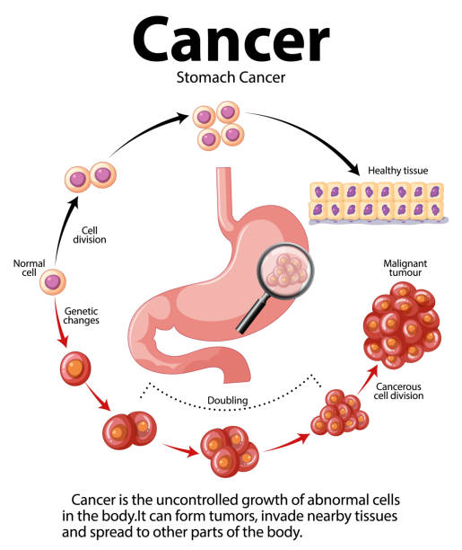 690 Cancer De Lestomac Stock Illustrations Graphiques Vectoriels