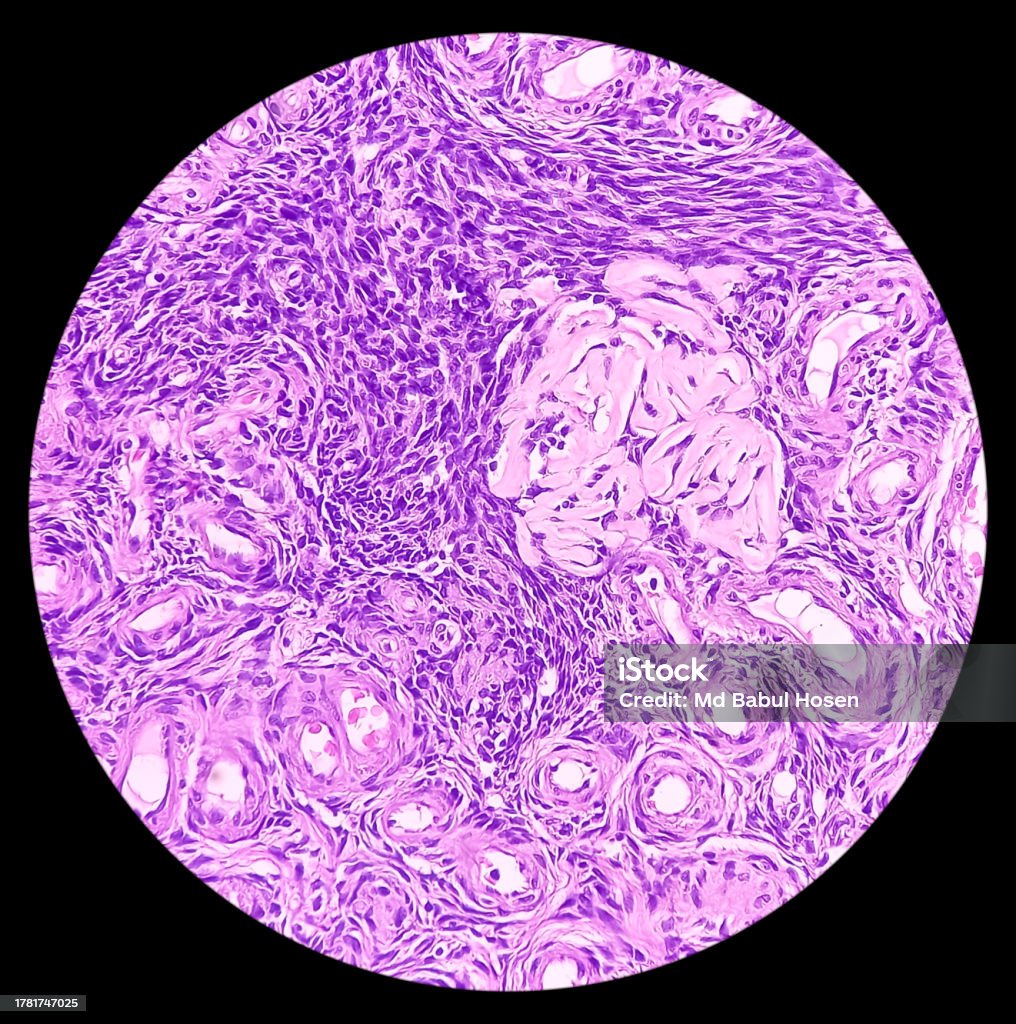 Photo Of Benign Brenner Tumor Of Ovary Showing Tumor Sheet On The Right