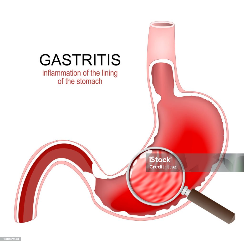 Gastritis Stomach Inflammation Stock Illustration Download Image Now Abdomen Anatomy