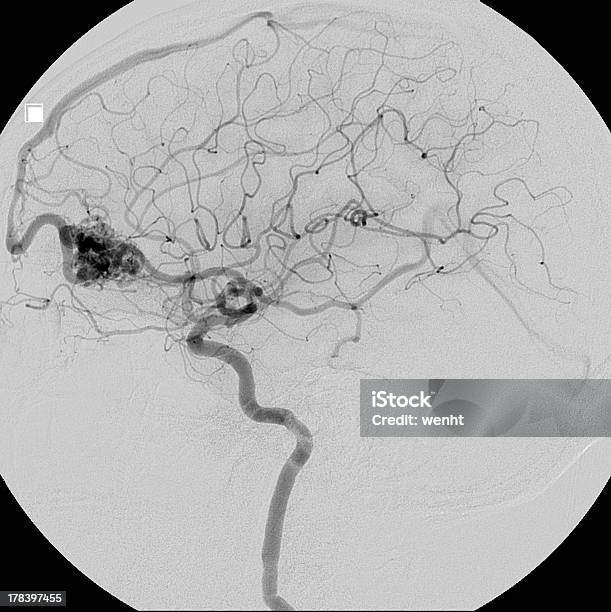 Arteriovenous 기형 뇌 뇌에 대한 스톡 사진 및 기타 이미지 뇌 동맥 조영도 대뇌 Istock