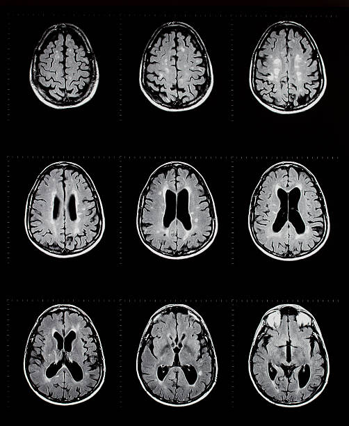 Healthy Brain Vs Ms Brain Healthy Brain Vs Ms Brain