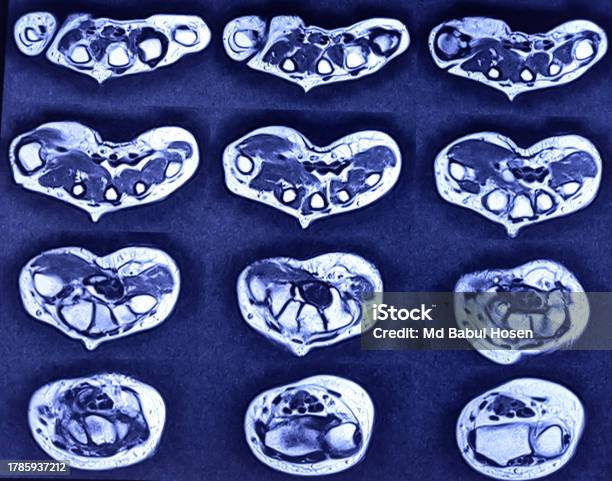Mri Gambar Sinarx Tangan Manusia Dari Berbagai Sudut Tampilkan Tulang