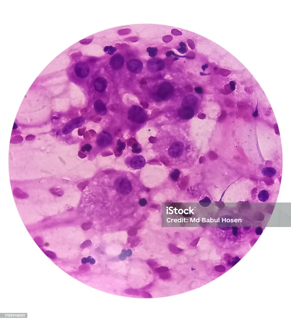 Fna Cytology Of Swelling Of Chest Wall Infected Epidermal Inclusion Cyst Commonly Called