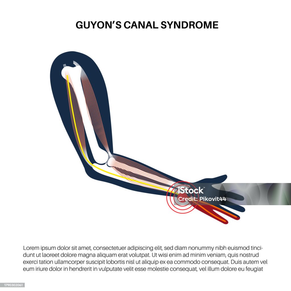 Guyons Canal Syndrome Stock Illustration Download Image Now Anatomy Arm Bone Istock