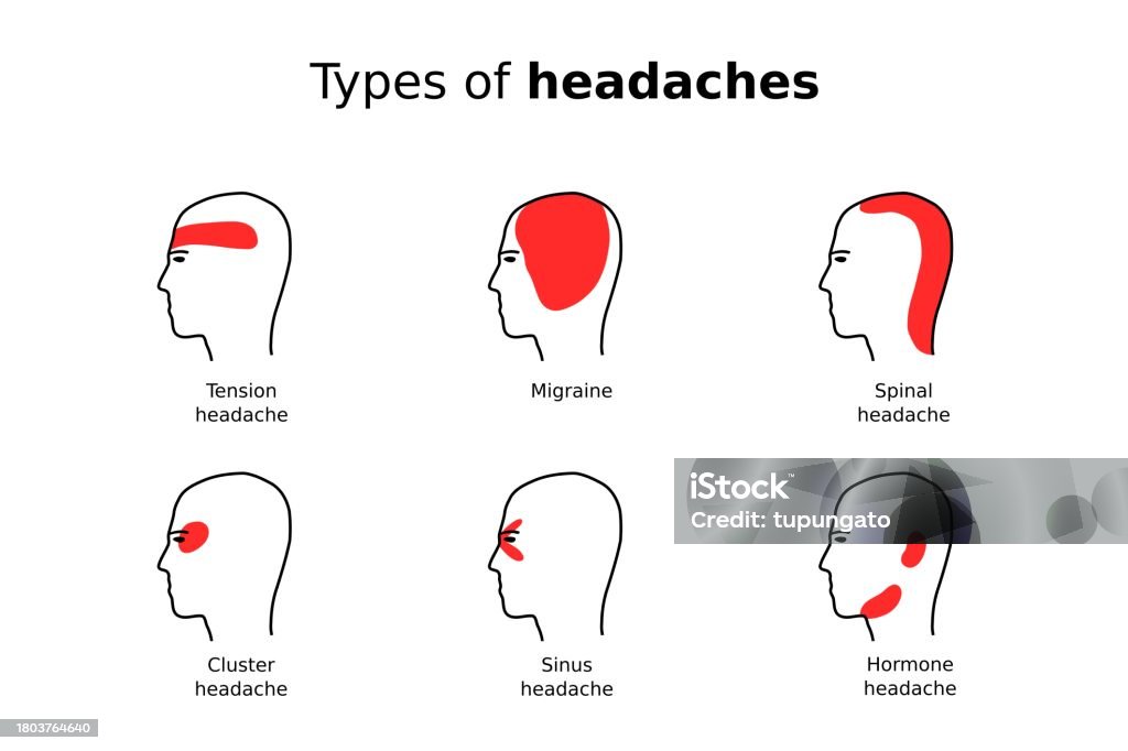 Types Of Headaches Vector Infographic Stock Illustration - Download ... Types Of Headaches Vector Infographic Stock Illustration - Download ...