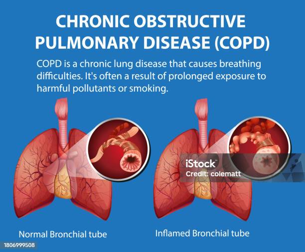 Éducation Scientifique De Lanatomie Humaine Infographie Sur La Mpoc