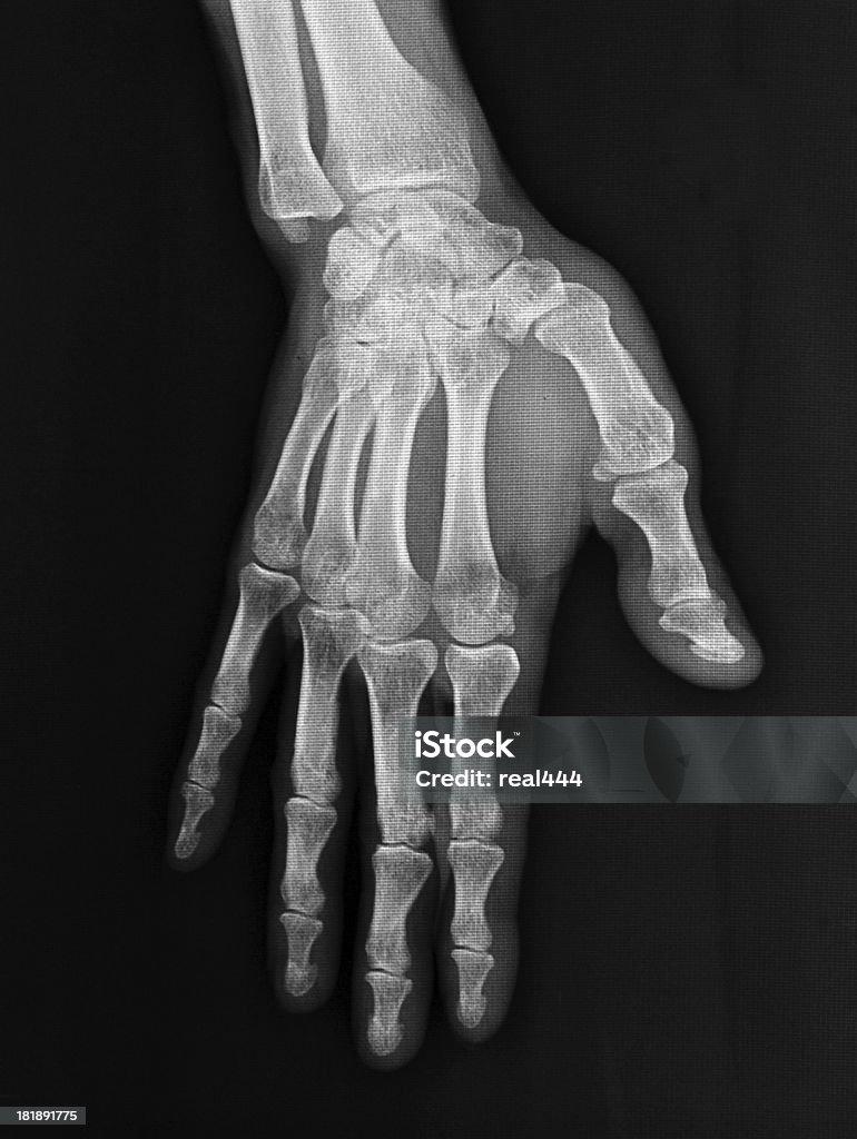 Imagen De Rayos X De Manos Foto de stock y más banco de imágenes de ... Imagen De Rayos X De Manos Foto de stock y más banco de imágenes de ...