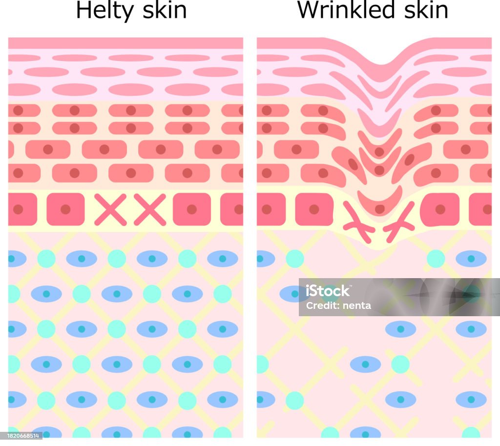 Cross Section Of Healthy Skin And Wrinkled Skin Stock Illustration