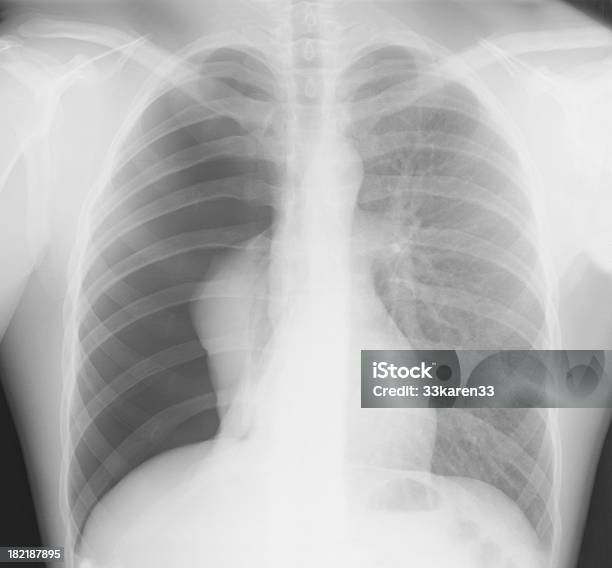 X레이 Of 기흉 기흉에 대한 스톡 사진 및 기타 이미지 기흉 엑스레이 이미지 흉부 상체 Istock
