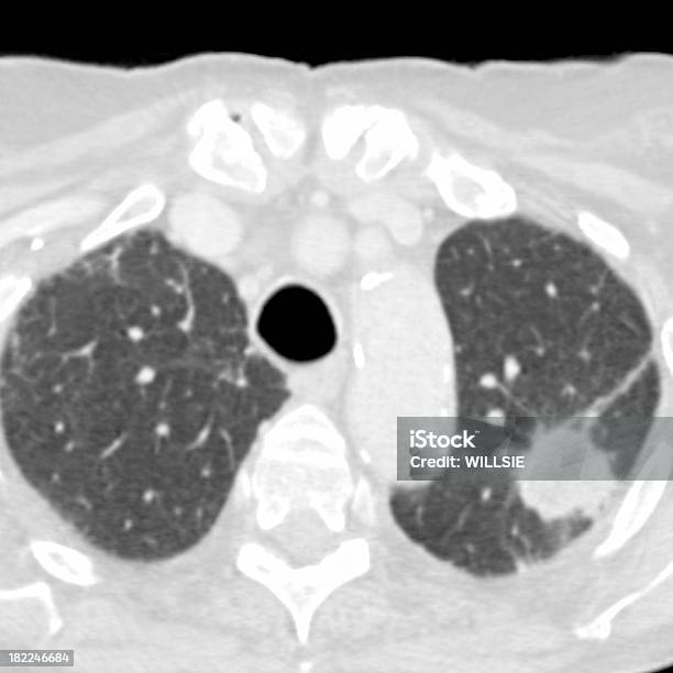 Ct Scan Perokok Dada Dengan Kanker Paruparu Foto Stok Unduh Gambar