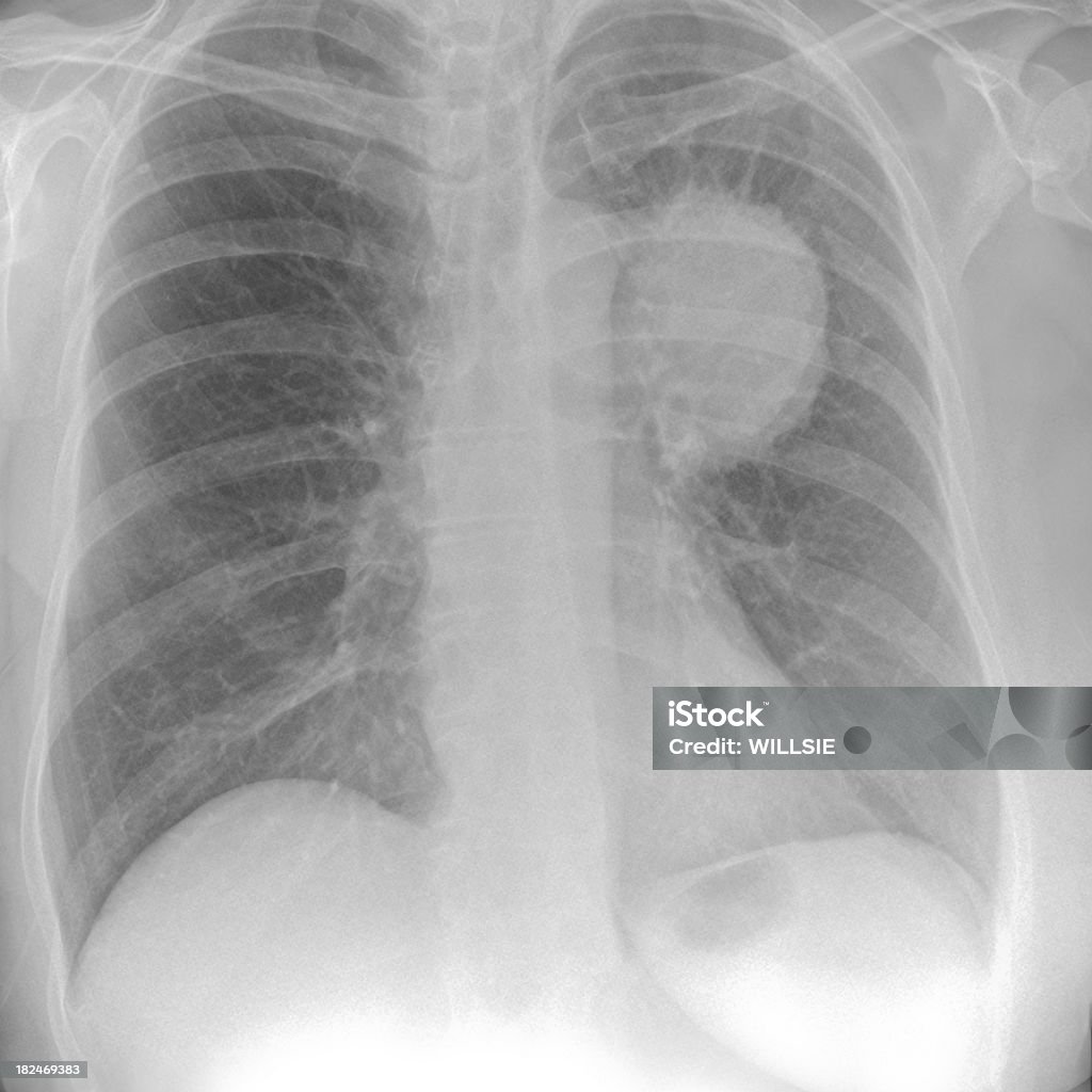 Xray Dada Digital Perokok Wanita Dengan Kanker Paruparu Foto Stok