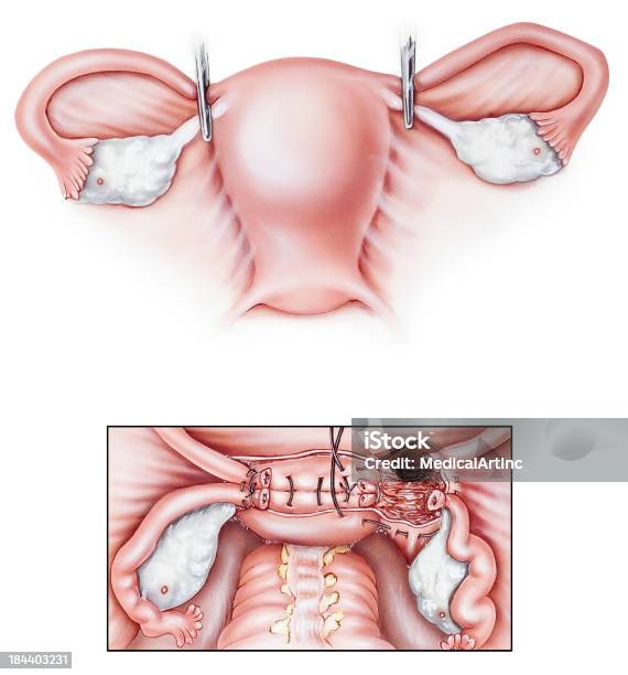 Uterus Hysterectomy Stock Illustration Download Image Now
