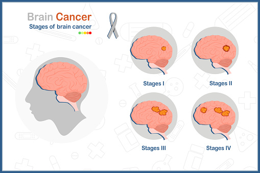 Stages Of Brain Cancer Stock Illustration Download Image Now Alertness Anatomy Biology