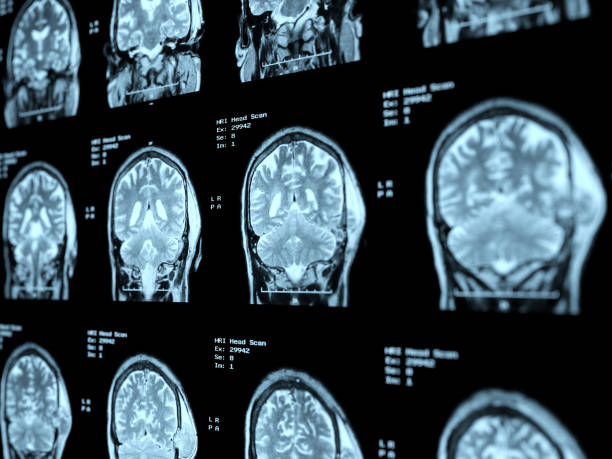 17.800+ Tumor Otak Foto Stok, Potret, & Gambar Bebas Royalti - iStock 17.800+ Tumor Otak Foto Stok, Potret, & Gambar Bebas Royalti - iStock