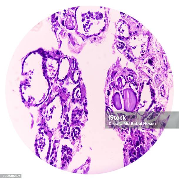 Thyroid Cancer Tracheal Gland Involved By Tumor Microscopic Image Of