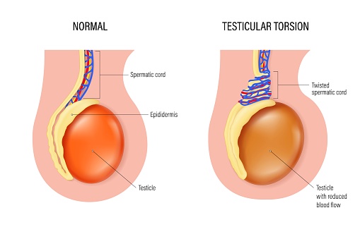 Testicular Torsion Vector Comparison Of Normal And Testicular Torsion Testicular Disease Male
