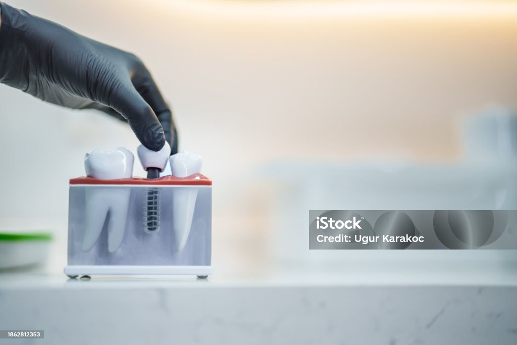 Selective Focus On Model Of Tooth And Implant At Dentist Clinic Stock