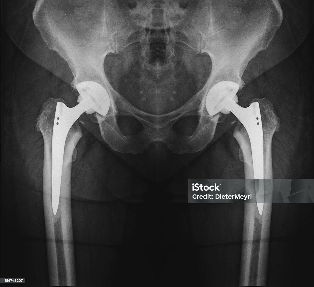 Xray Dari Arthroplasty Pinggul Total Foto Stok - Unduh Gambar Sekarang ... Xray Dari Arthroplasty Pinggul Total Foto Stok - Unduh Gambar Sekarang ...