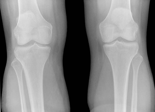 40+ Normal Knee X Ray Stock Photos, Pictures & Royalty-Free Images - iStock 40+ Normal Knee X Ray Stock Photos, Pictures & Royalty-Free Images - iStock