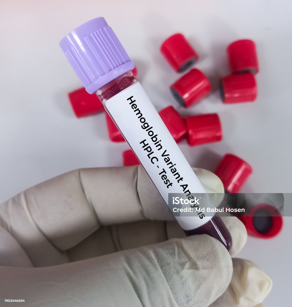 Hemoglobin Variant Analysis Hplc Test To Diagnosis Of Hb A2 Hb F And