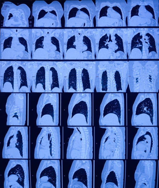 Multi slice HRCT scan of chest showing normal study, normal appearance ...