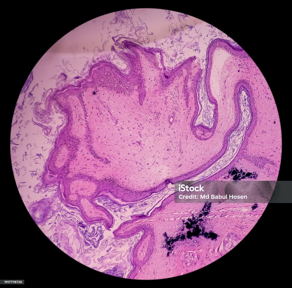 Photo Libre De Droit De Mature Cystic Teratoma Ovarian Cyst Biopsy Show