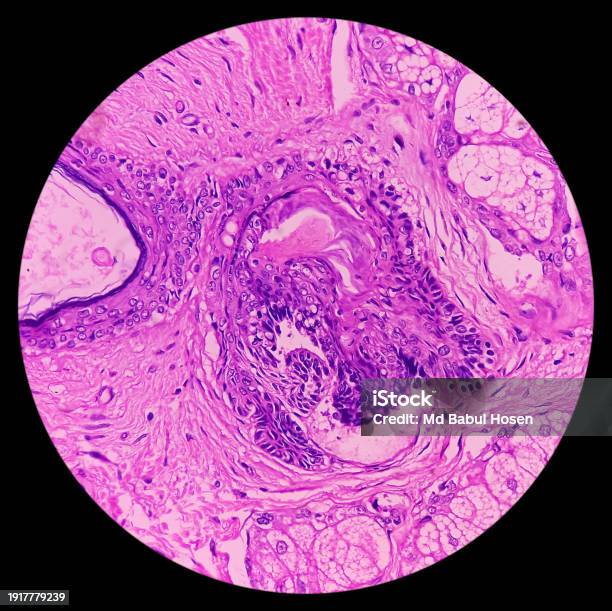 Mature Cystic Teratoma Ovarian Cyst Biopsy Show Cyst Wall Of Skin And