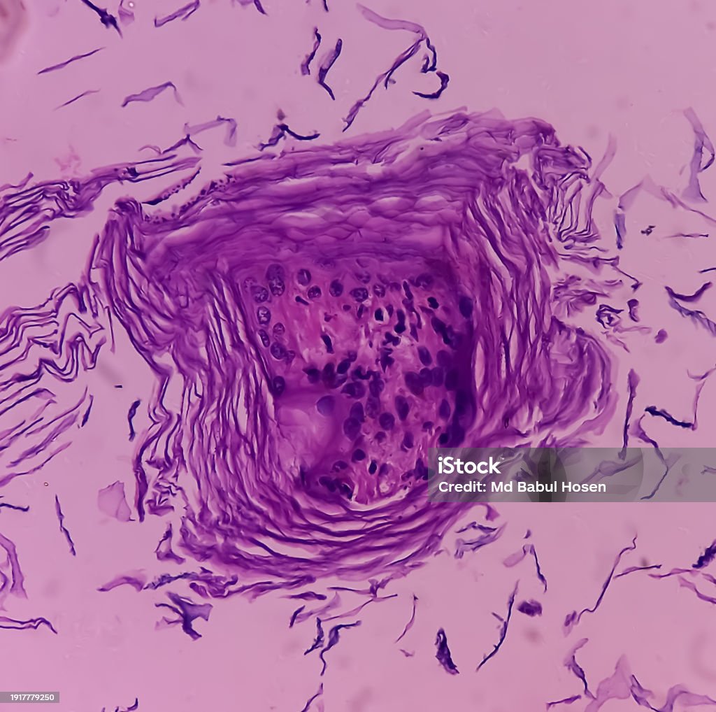 Mature Cystic Teratoma Ovarian Cyst Biopsy Show Cyst Wall Of Skin And