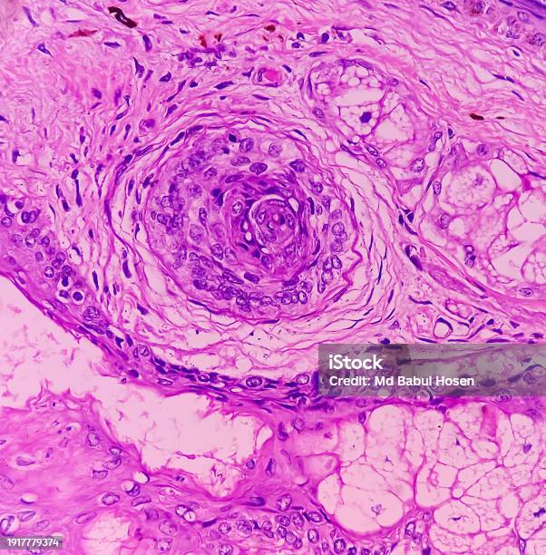 Photo Libre De Droit De Mature Cystic Teratoma Ovarian Cyst Biopsy Show