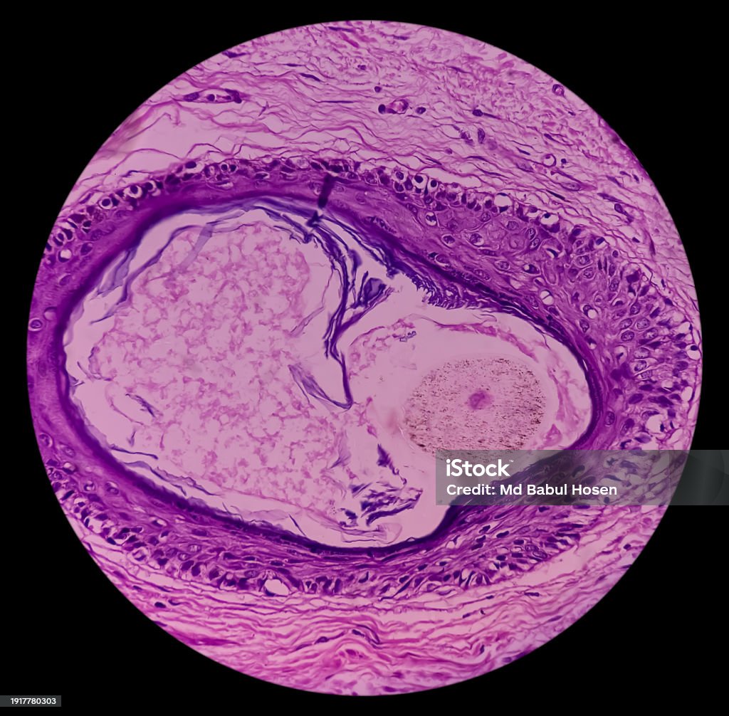 Mature Cystic Teratoma Ovarian Cyst Biopsy Show Cyst Wall Of Skin And