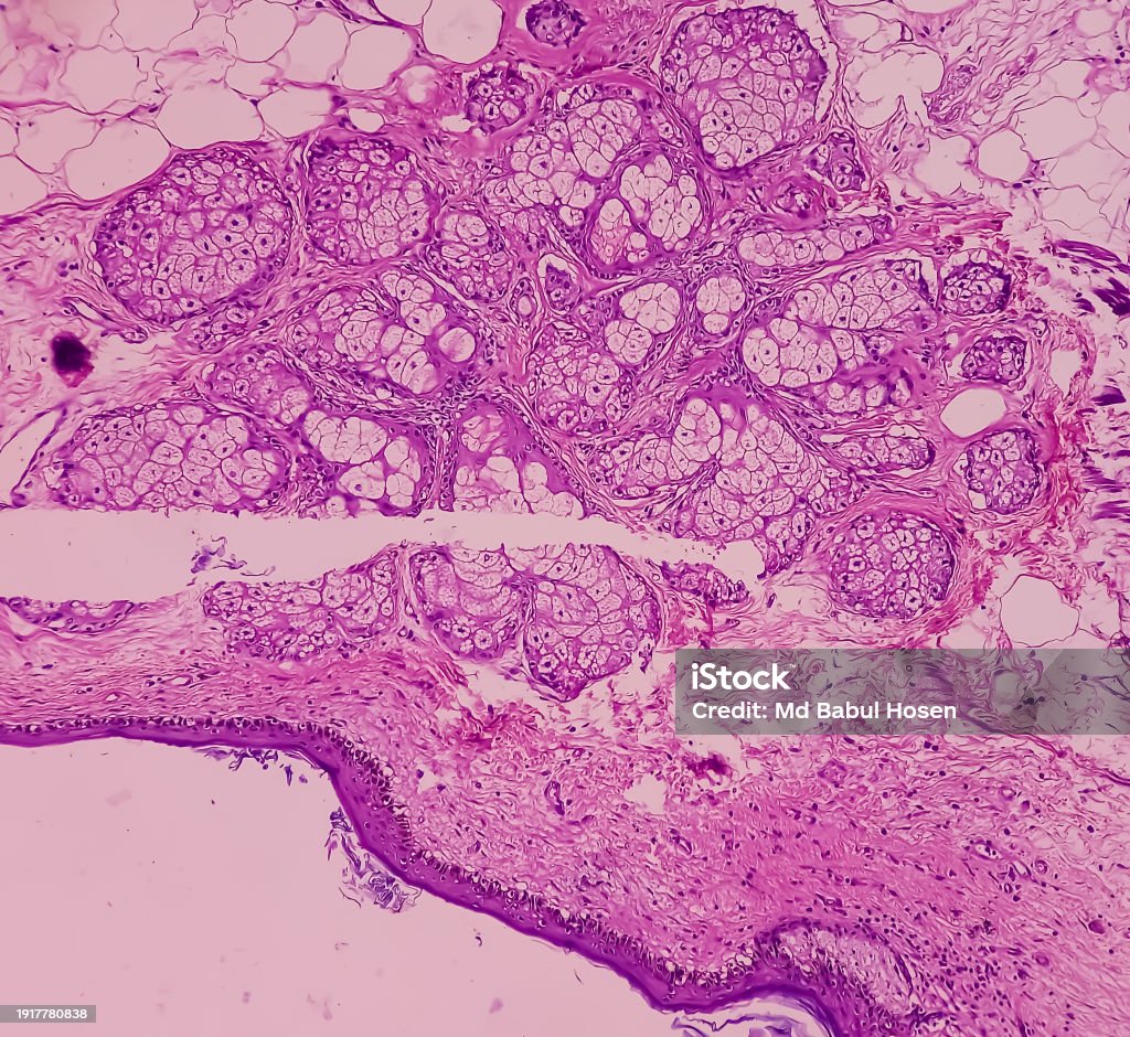 Mature Cystic Teratoma Ovarian Cyst Biopsy Show Cyst Wall Of Skin And